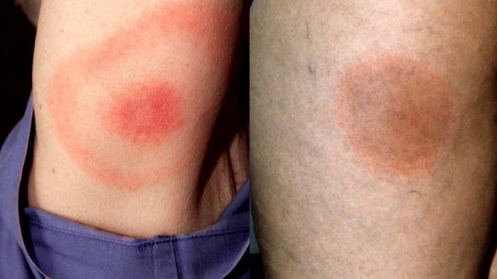 Lesson plan: How mice could help fight Lyme Disease | PBS News Hour ...